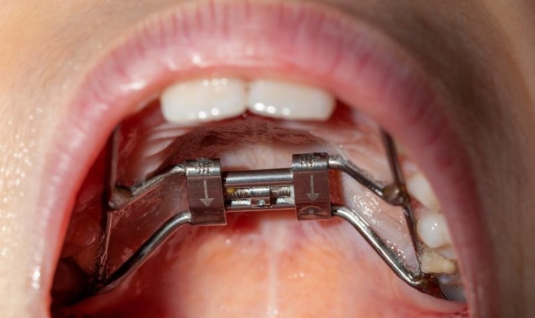¿Qué es el disyuntor Hyrax y cómo funciona? | Moonz